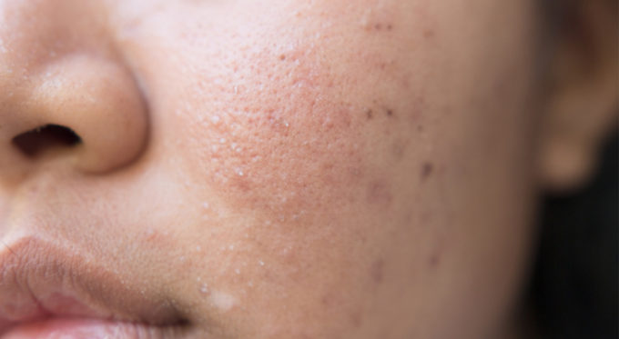 Nodular Acne: Understand, Treat And Get Rid Of It Today!