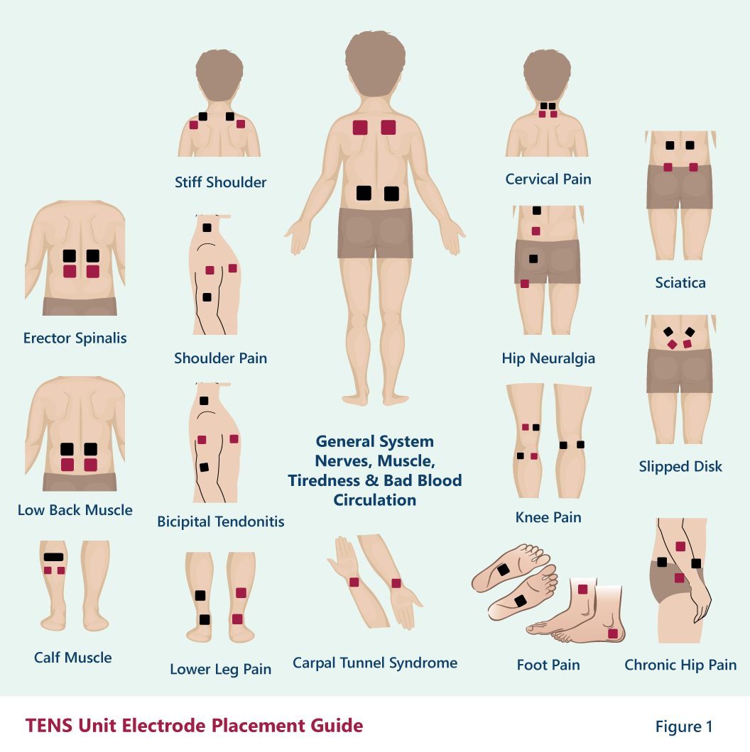 Tens Unit Electrode Placement Chart Happy Living Tens Unit Electrode Placement Chart Happy Living