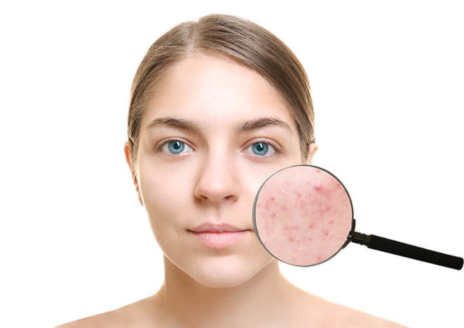 Dermaroller Acne Scars: A Guide To Your Best Option